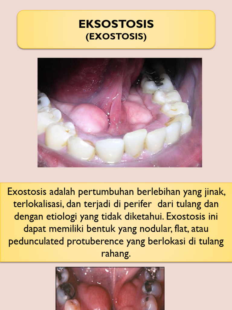Panduan Exostosis Rahang | PDF