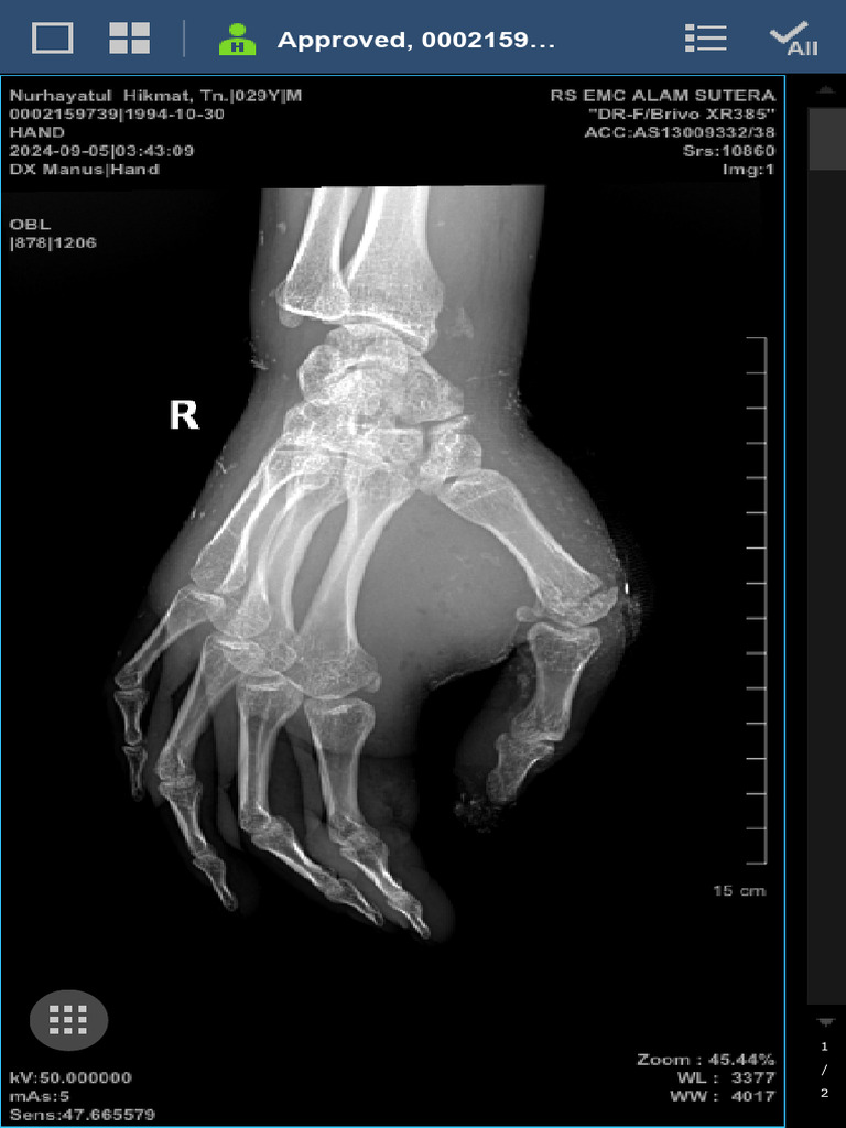 Fracture Manus | PDF