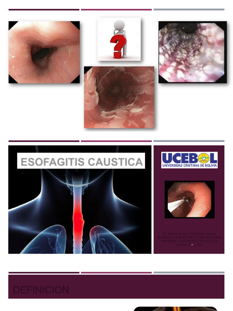 2. Esofagitis Caustica - Mallory Weiss | PDF | Gastroenterología | Causas de la muerte