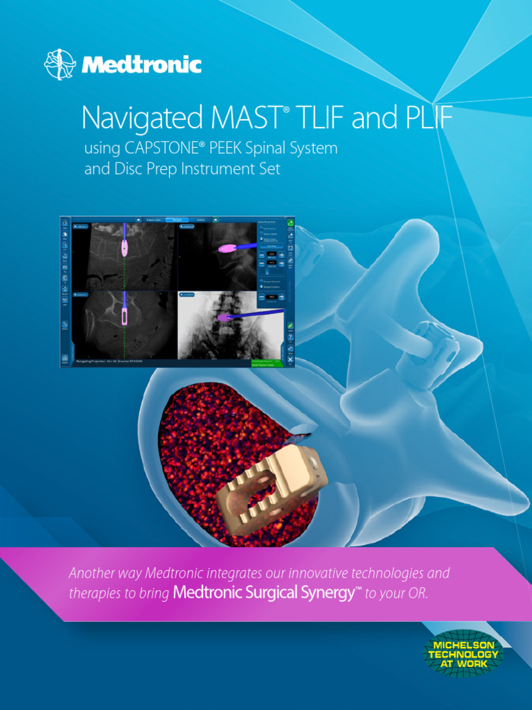 NAV MIS TLIF PLIF Disc Prep Instruments Surgical Technique - PMD012511 ...
