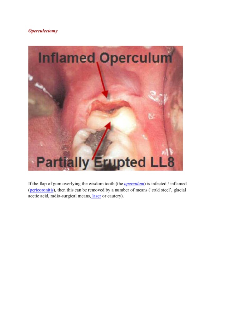 Operculectomy | PDF | Human Anatomy | Health Sciences