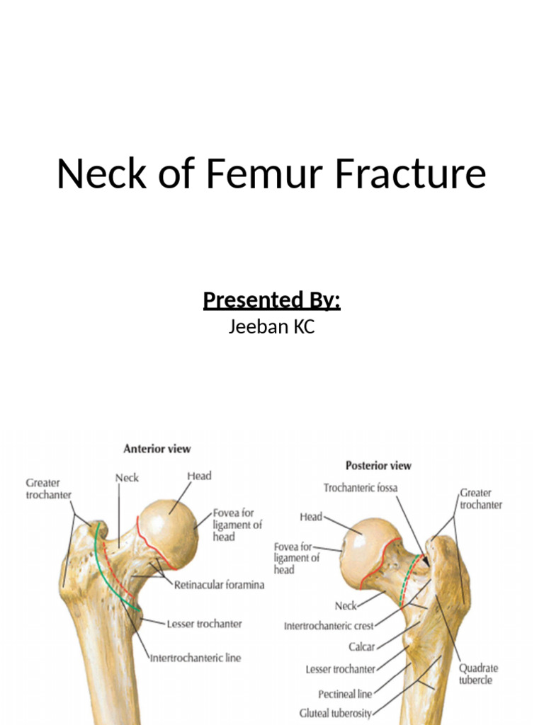 Neck of Femur Fracture Overview | PDF | Hip | Clinical Medicine
