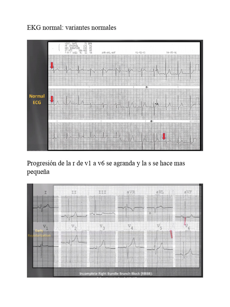 EKG Variantes Normales, LVH RVH, Dilatacion Auricular | PDF ...