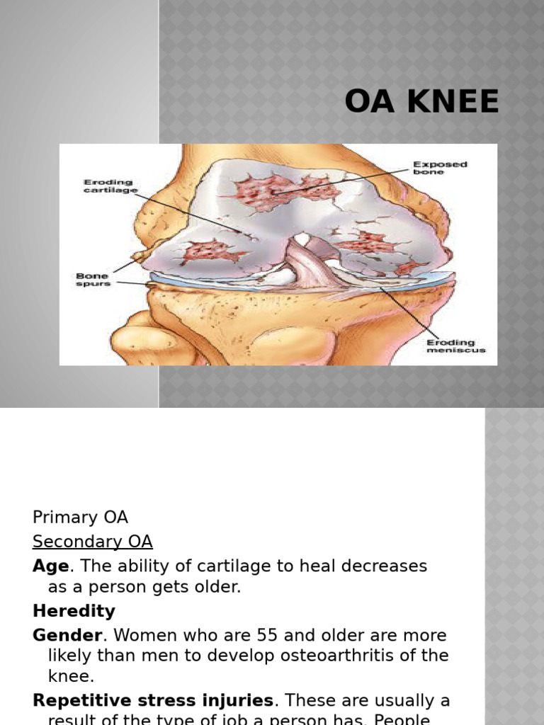 OA KNEE | PDF | Knee | Osteoarthritis