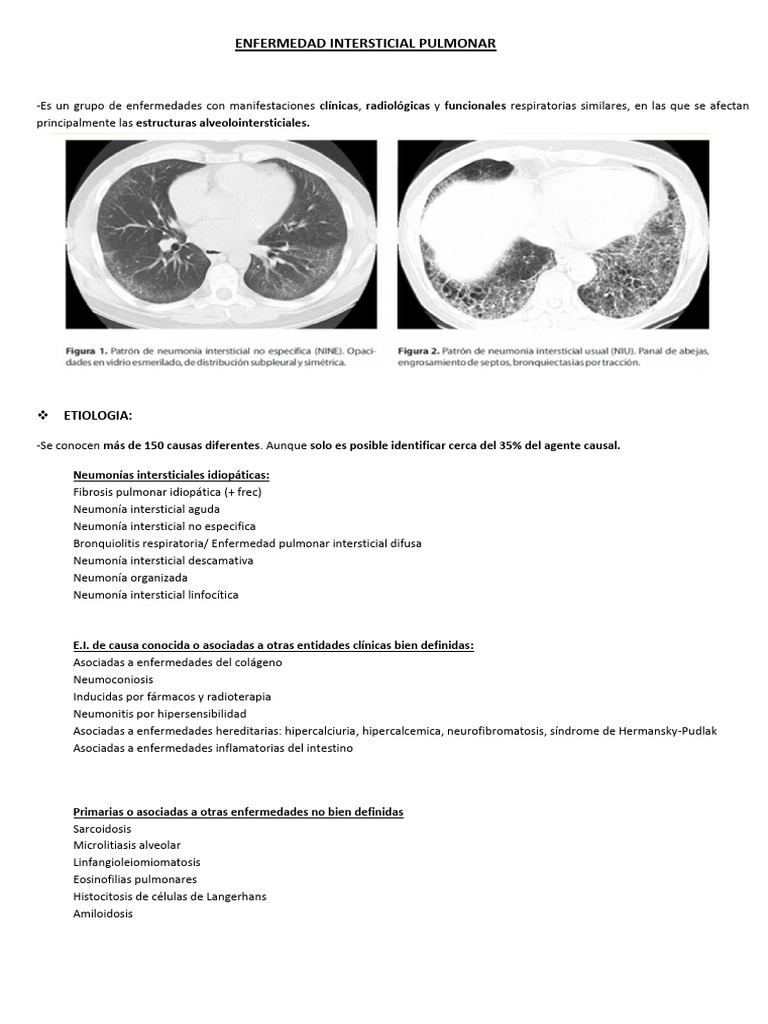 ENFERMEDAD INTERSTICIAL PULMONAR | PDF | Neumonía | Tos