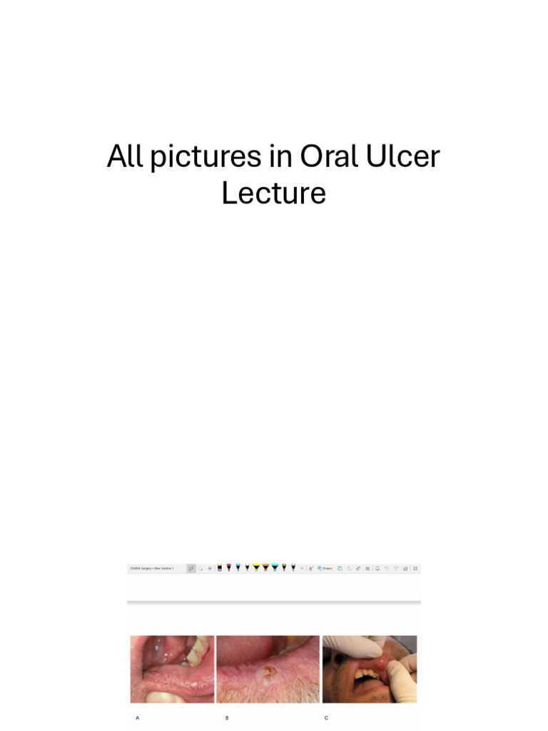 All Pics in Oral Ulcer Lecture | PDF