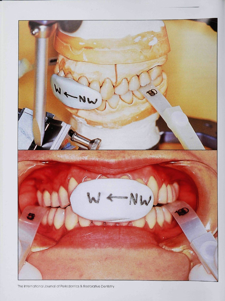 Twin-Stage Procedure. Part 2 A Clinical Evaluation Test | PDF | Tooth ...