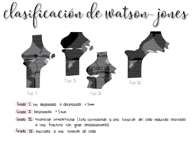 Clasificación de Fracturas Watson-Jones | PDF