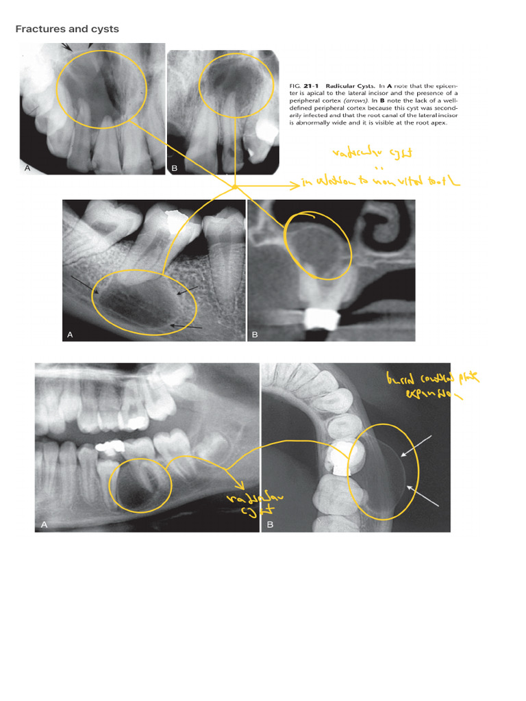 Fractures and Cysts | PDF