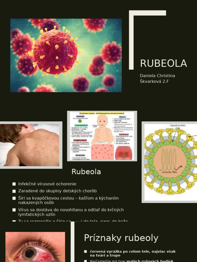 Rubeola | PDF