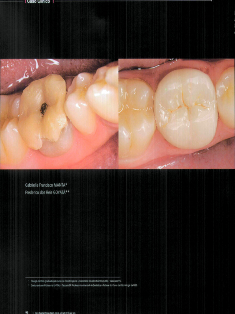 Endocrown: Restauração de Dente Desvitalizado | PDF | Dente humano ...