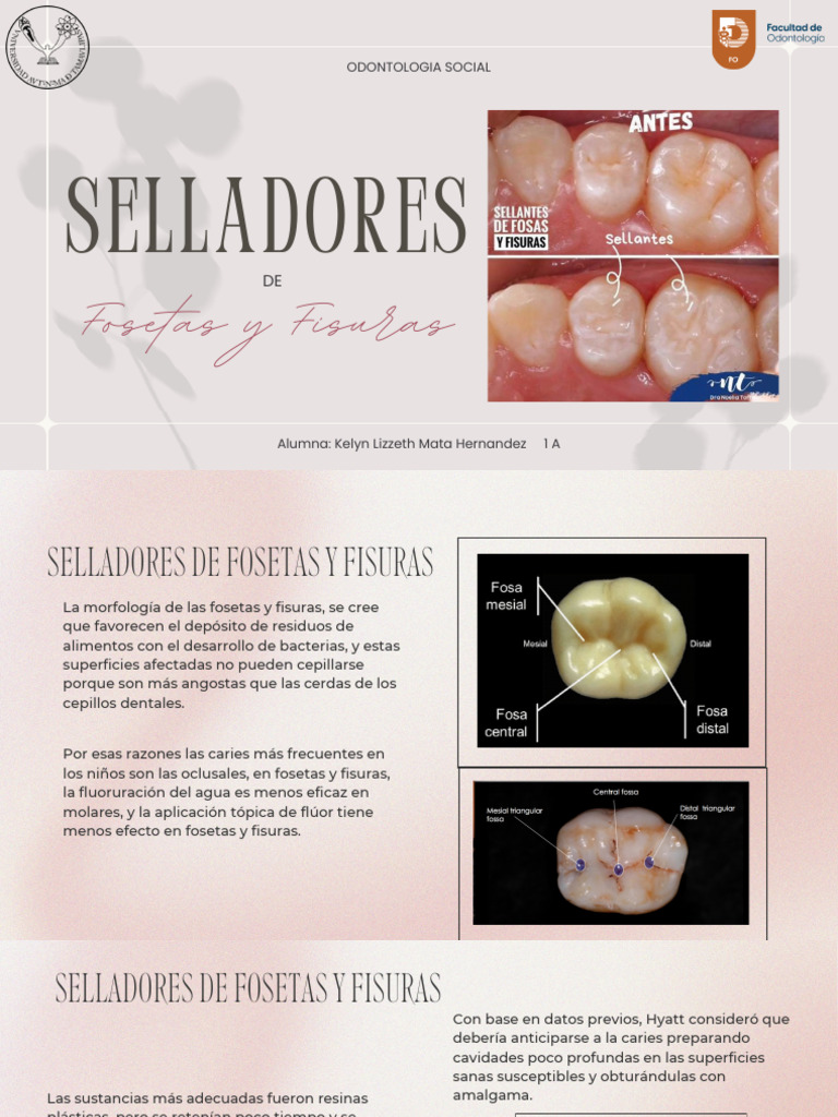 Selladores para Fosetas y Fisuras | PDF | Odontología
