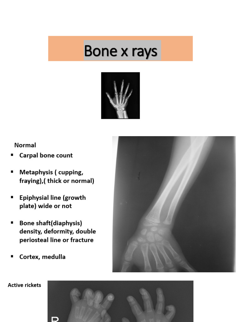 bone x rays | PDF