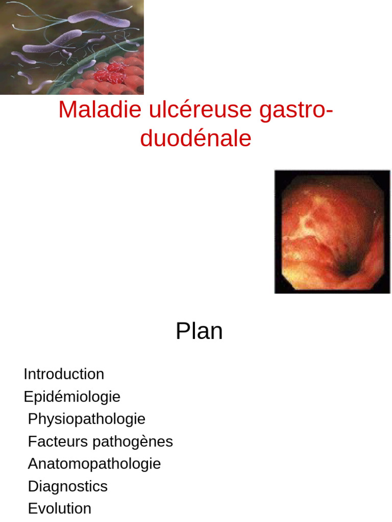 Ulcère Gastro-Duodénal : Diagnostic et Traitement | PDF | Estomac ...