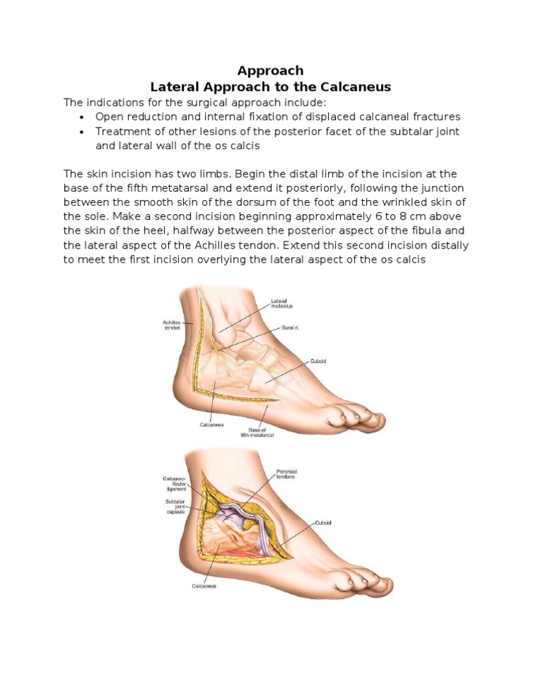 Lateral Approach for Calcaneus Fractures | PDF