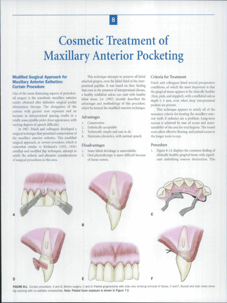 Cosmetic Treatment of Maxillary Anterior Pocketing | PDF | Mouth | Dentistry Branches