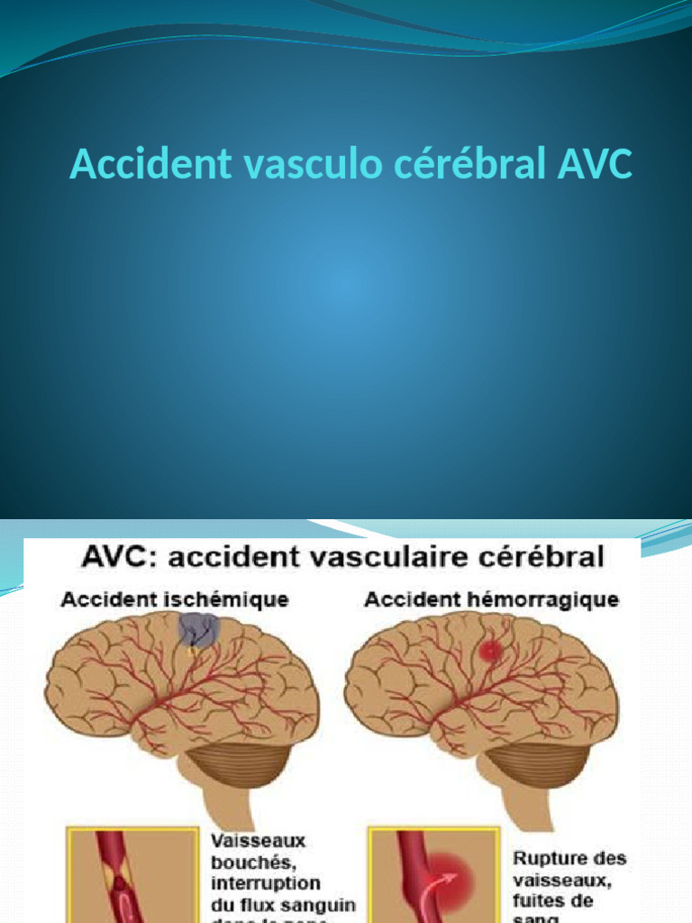 Accident Vasculo Cérébral AVC | PDF | Accident vasculaire cérébral | Maladies vasculaires