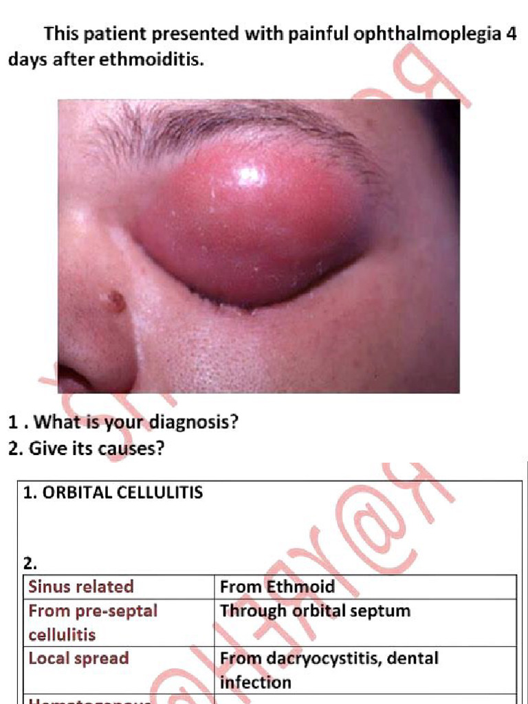 Eye Ospe 4-1-1 | PDF