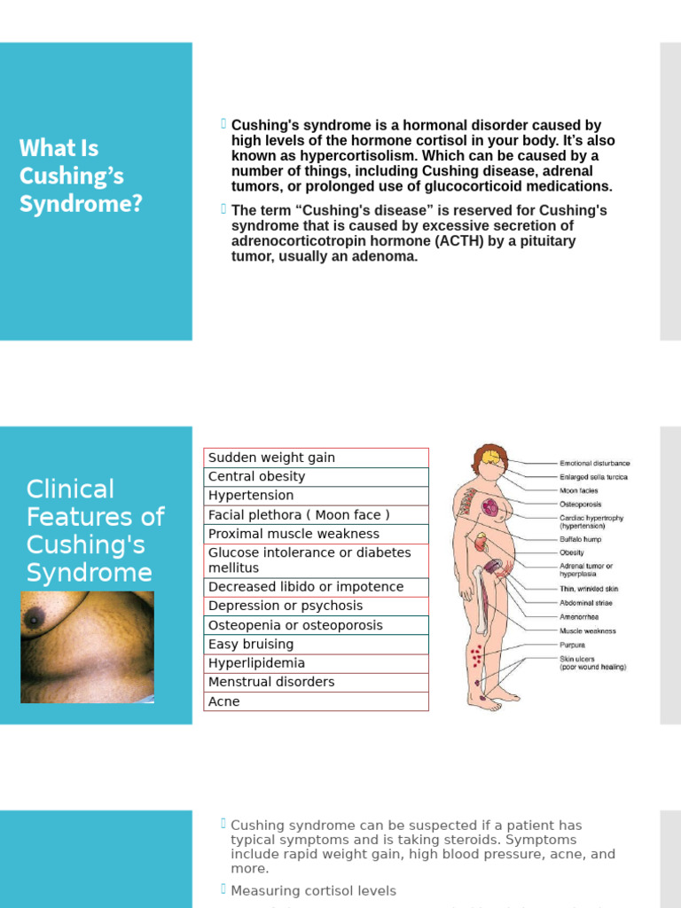 Understanding Cushing's Syndrome | PDF