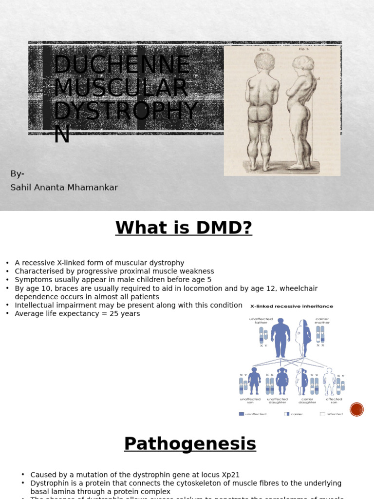 Overview of Duchenne Muscular Dystrophy | PDF | Musculoskeletal System ...
