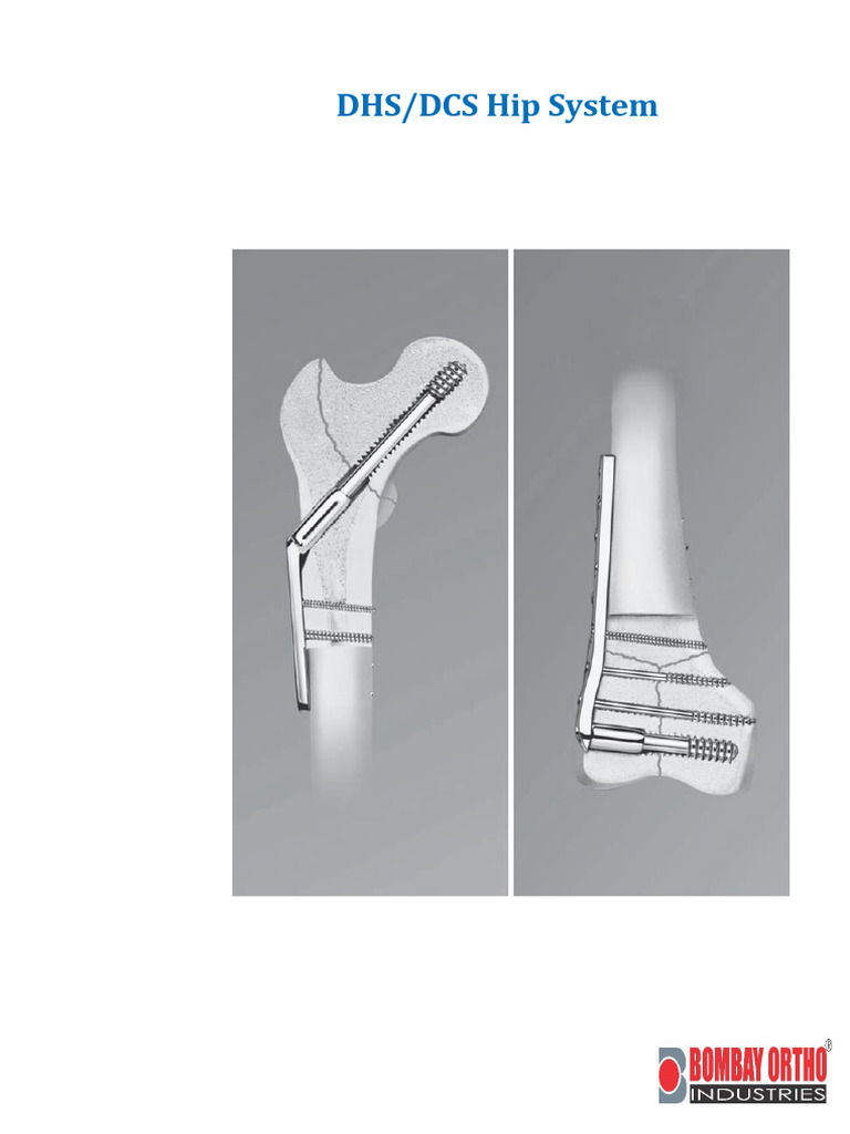 DHS/DCS Hip System Technique Guide | PDF | Hip | Screw