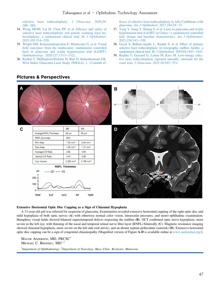 Extensive Horizontal Optic Disc Cupping As A Sign | PDF | Glaucoma ...
