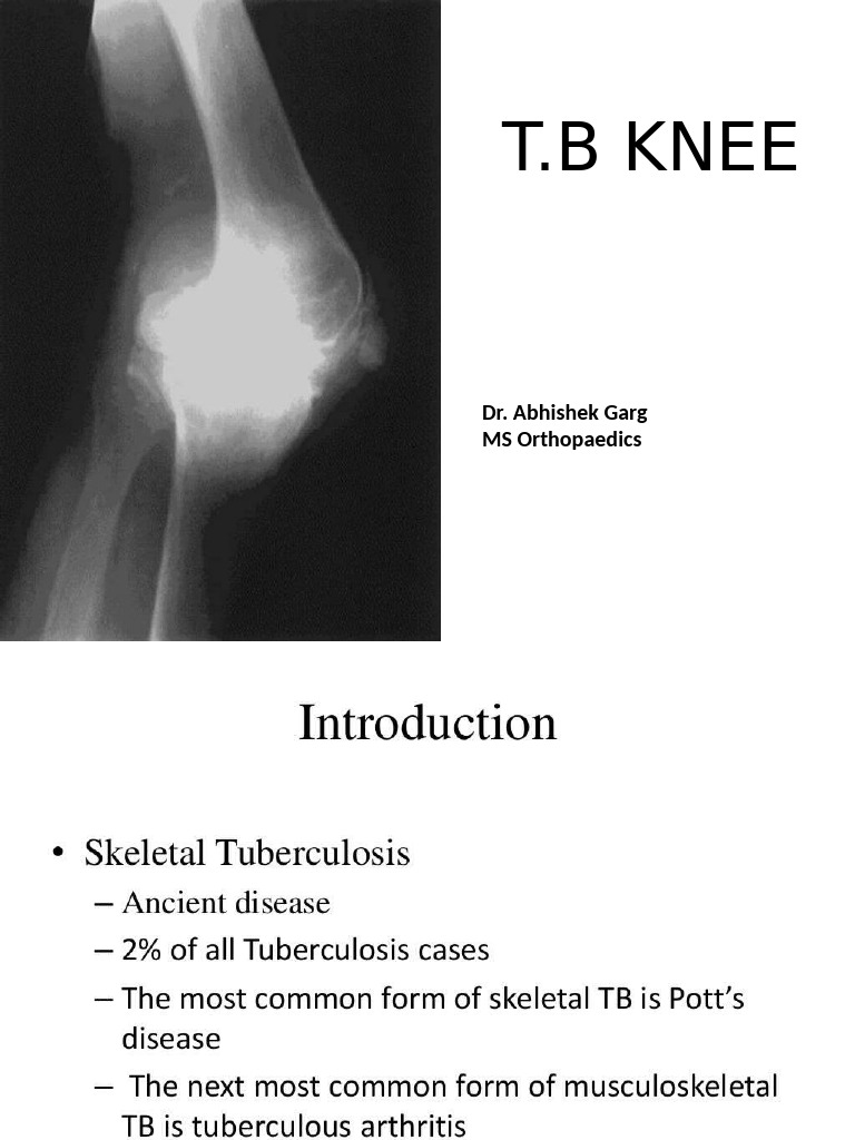 Tuberculosis of Knee | PDF
