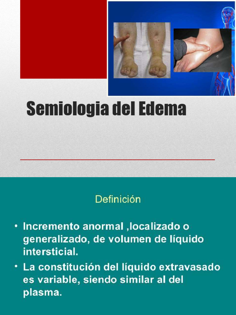 Semiologia Del Edema | PDF