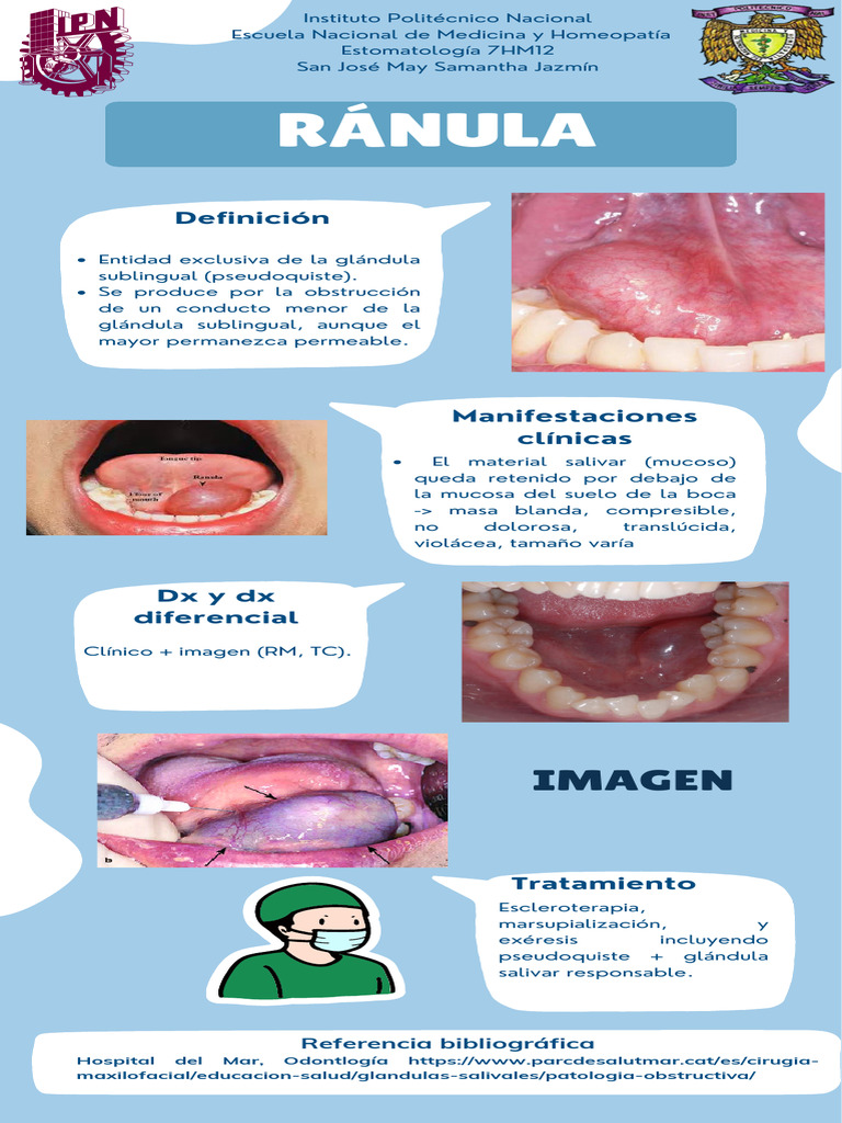 Ránula: Diagnóstico y Tratamiento | PDF
