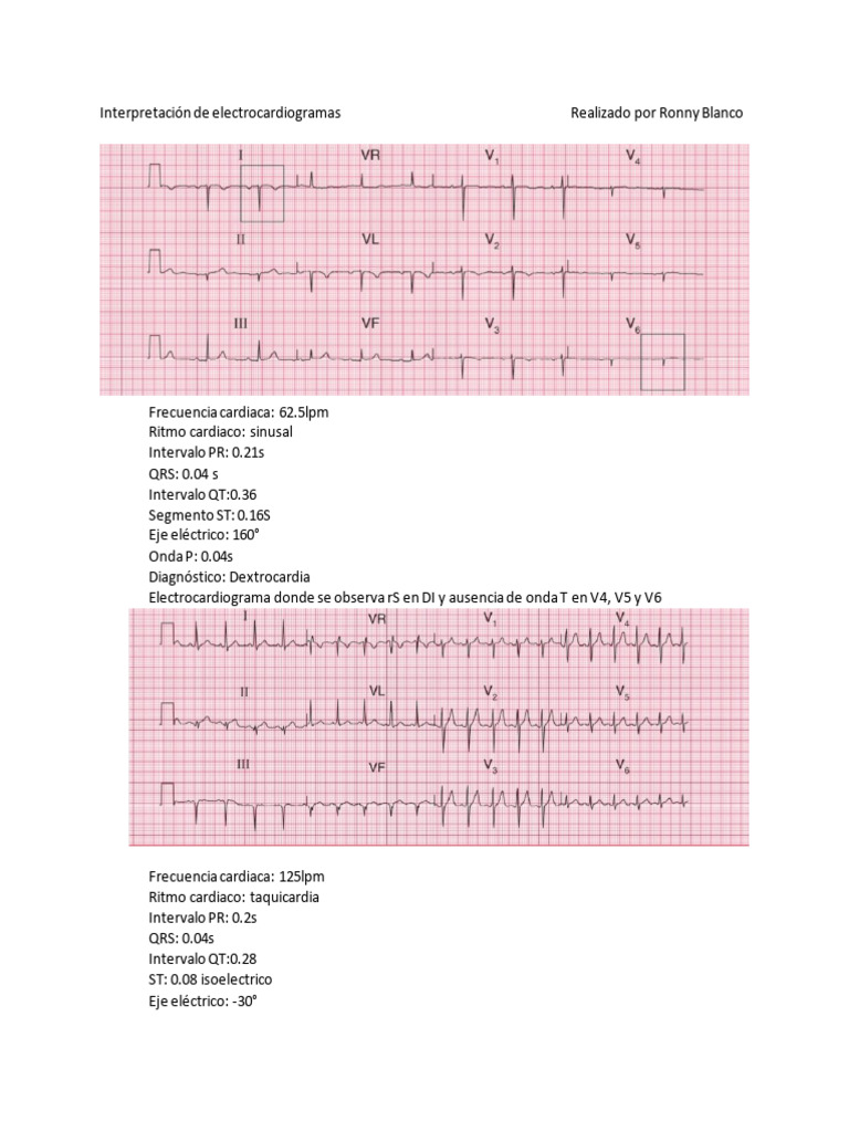 Interpretación de Electrocardiogramas | PDF | Electrocardiografia | Fisiología Cardiovascular
