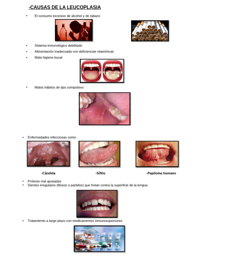 Causas de la Leucoplasia Oral | PDF