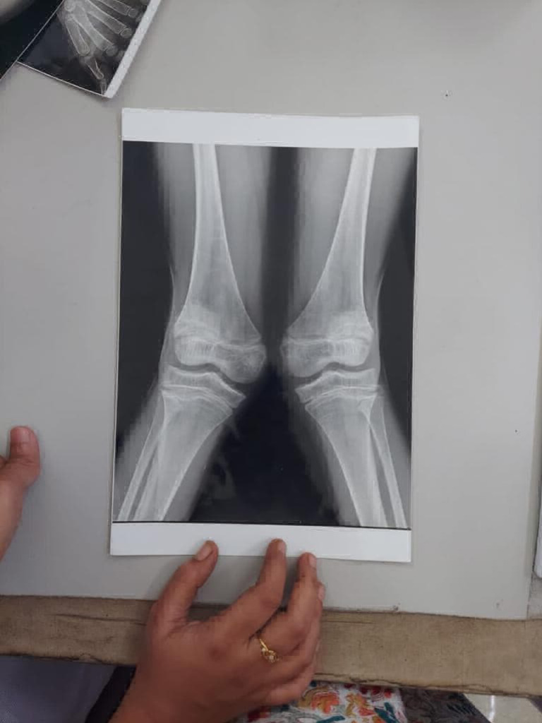 Orthopedic Fractures & Instruments Guide | PDF