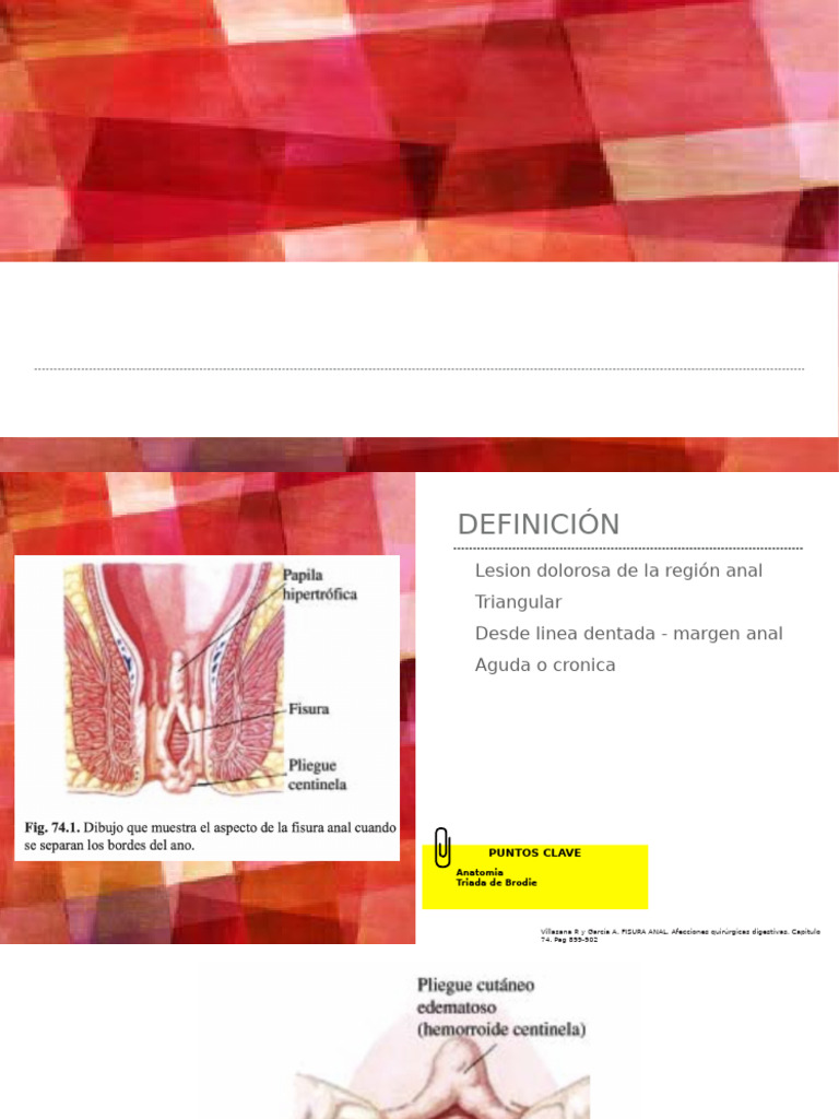 Fisura Anal | PDF | Estreñimiento | Hemorroides