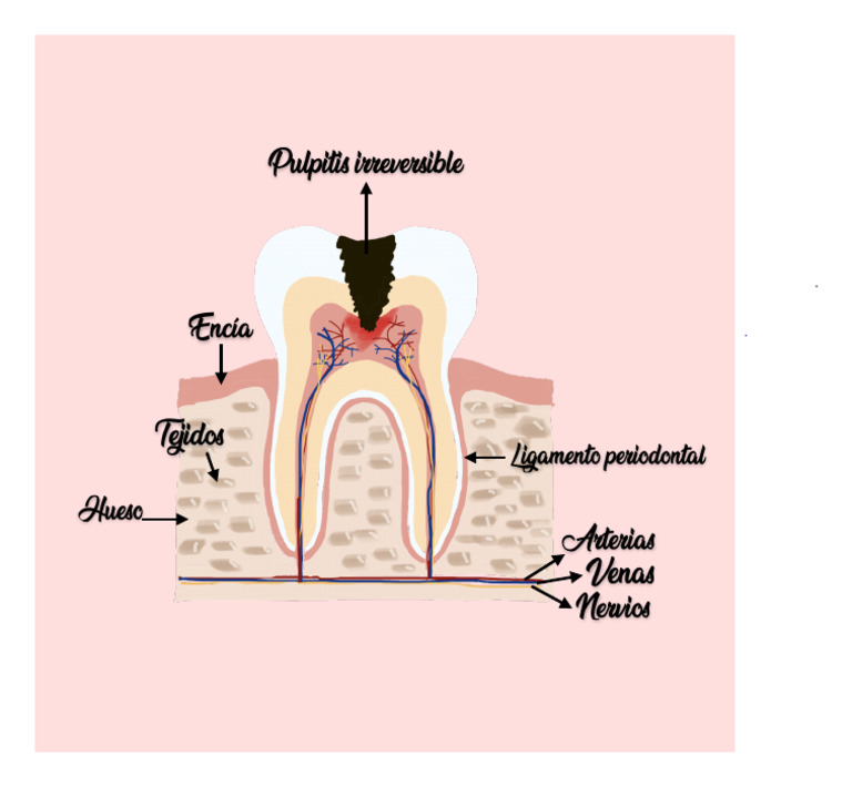 Pulpitis irreversible | PDF
