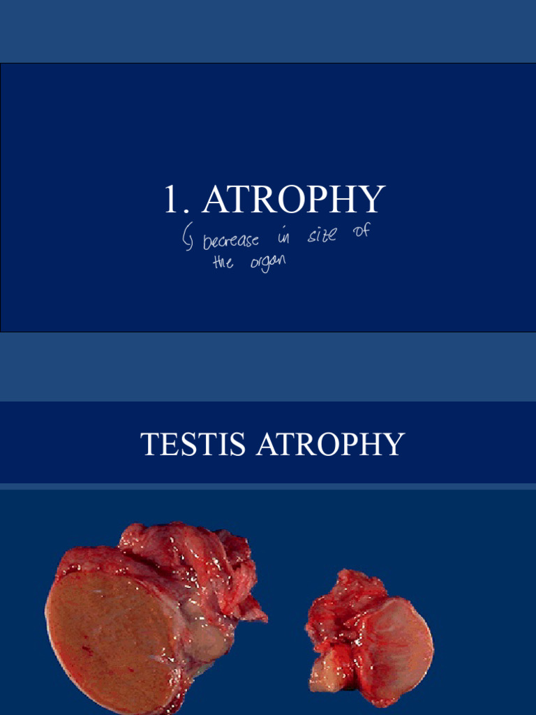 ALL 1st Bimo Demo | PDF | Inflammation | Necrosis