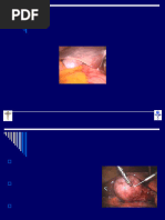 Laparoscopic Cholecystectomy With IOC | PDF | Gallbladder | Liver