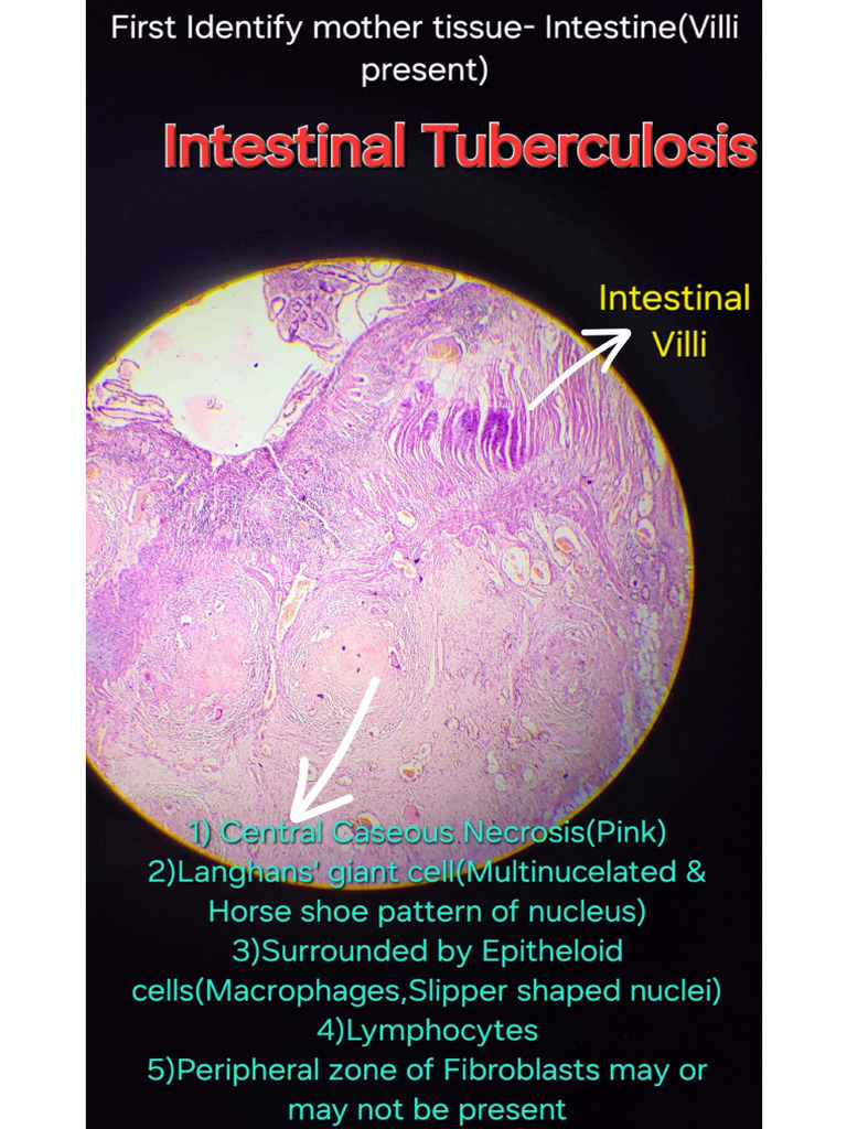 Pathology Slides - Tuberculosis of Intestine and Lymph Node | PDF