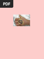 SOP for Pus Sample Collection and Analysis | PDF | Wound | Streptococcus