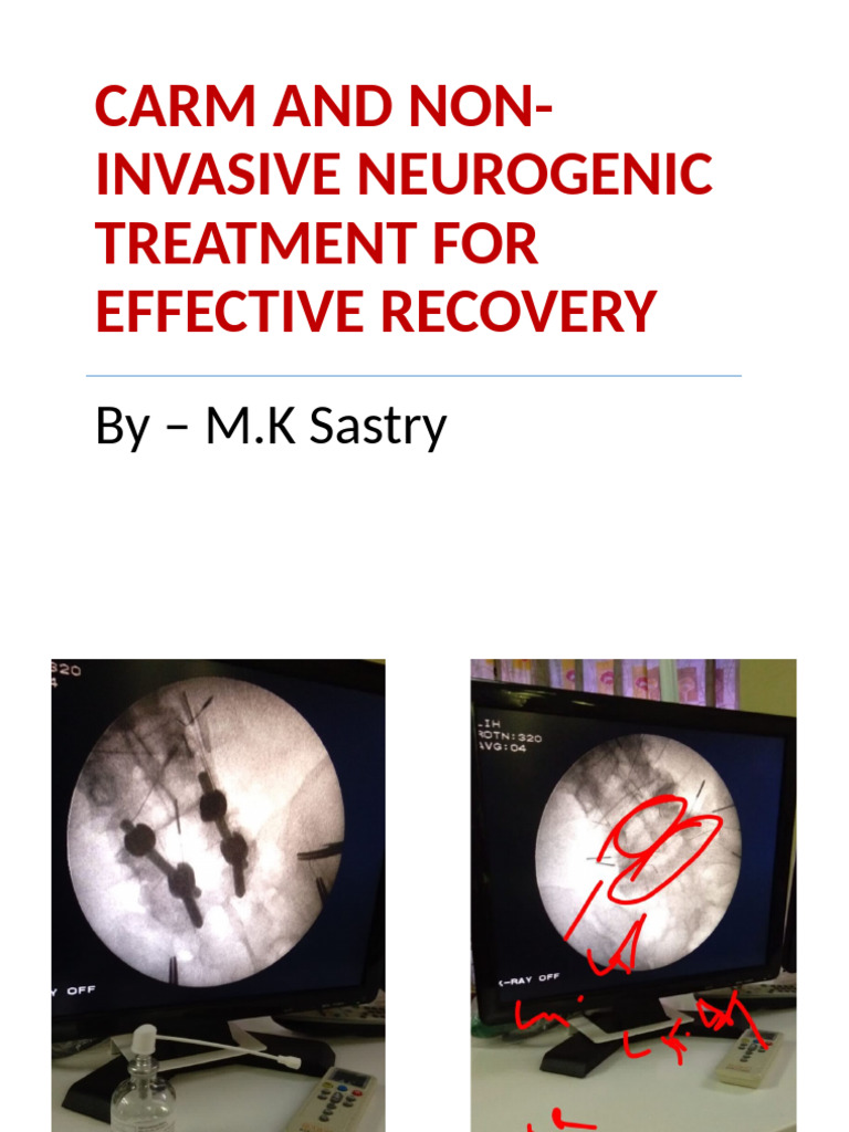 CARM AND NON INVASIVE NEUROGENIC TREATMENT FOR EFFECTIVE RECOVERY-1 | PDF