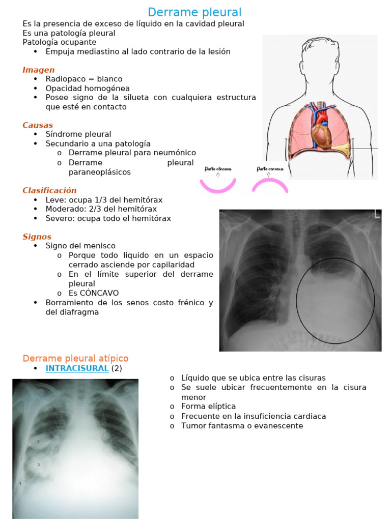 Derrame Pleural | PDF | Pulmón | Enfermedades y trastornos