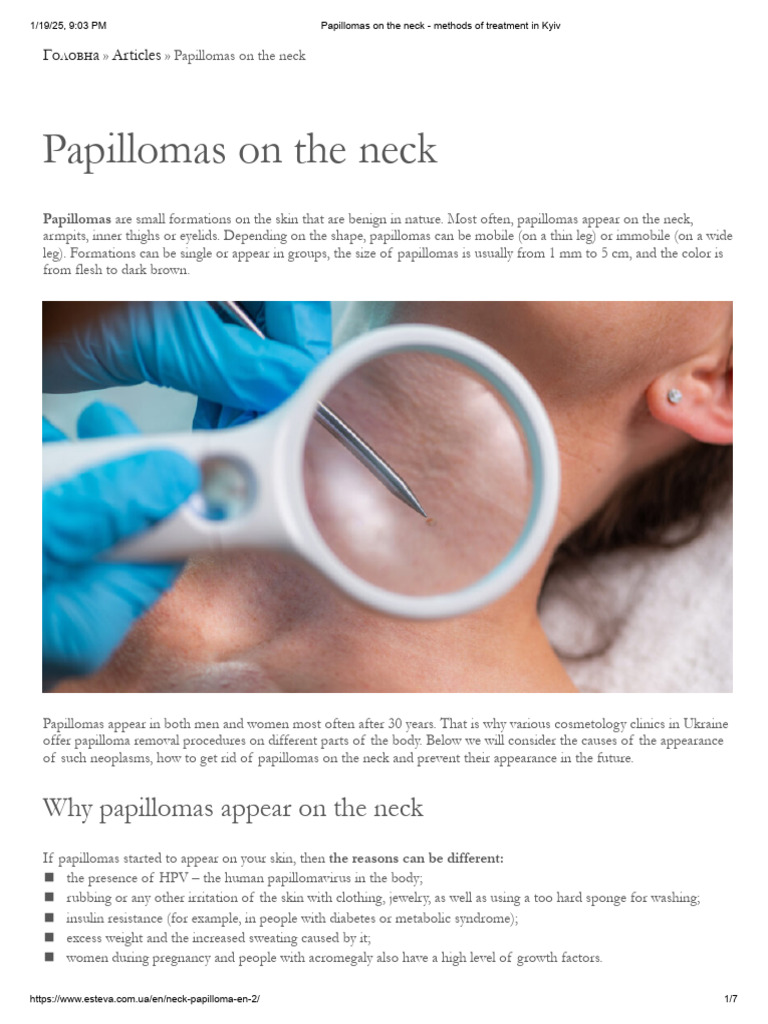 Papillomas On The Neck - Methods of Treatment in Kyiv | PDF | Surgery ...