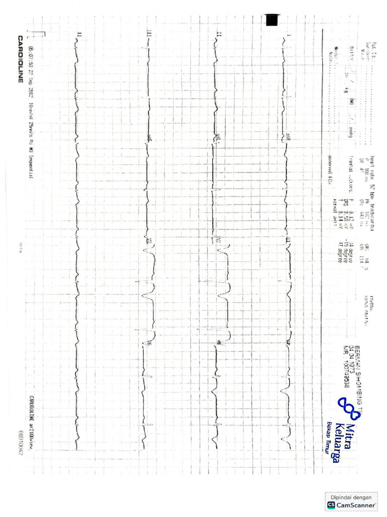 Hasil Ekg | PDF