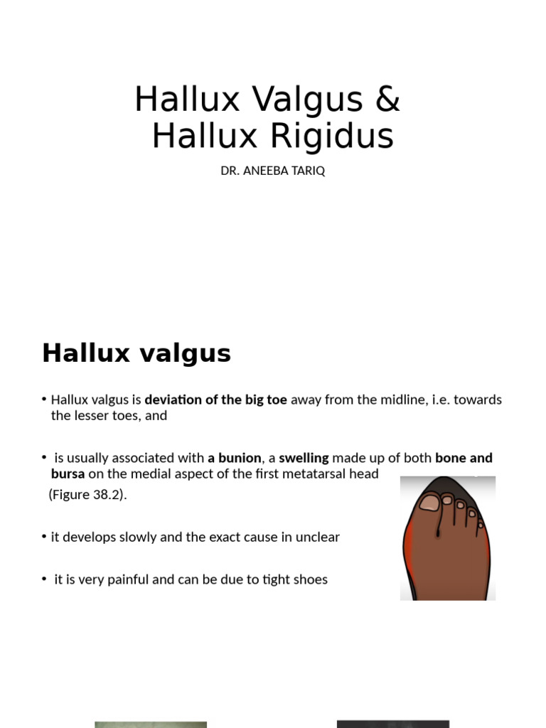 Hallux Varus Congenitus Overview | PDF