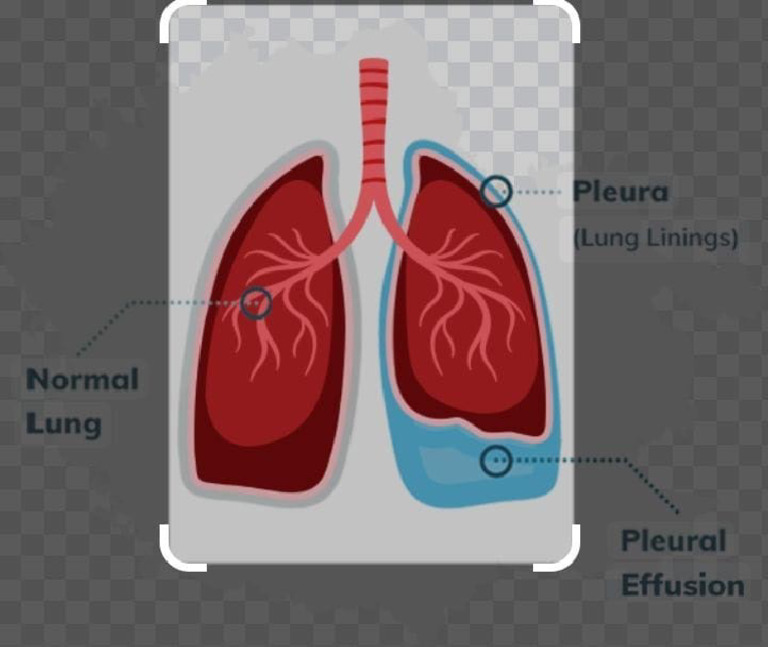 Lungs | PDF