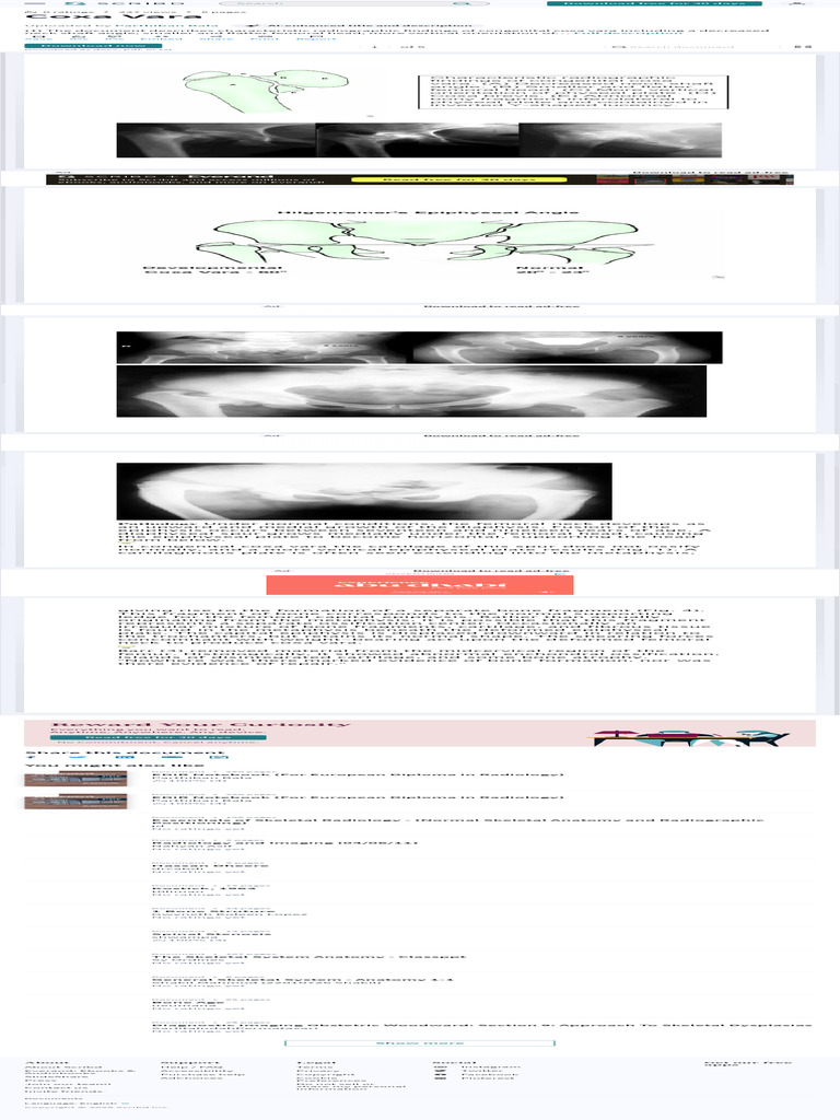 Coxa Vara PDF Bone Musculoskeletal System | PDF | Bone | Scribd