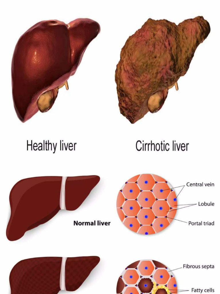 Liver Cirrhosis | PDF