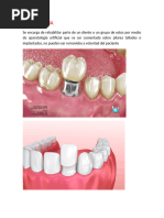 Diseño y Función de Pónticos en Prostodoncia | PDF | Diente