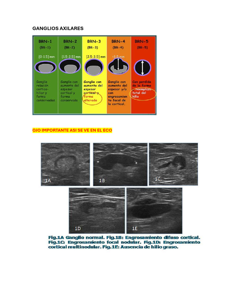 Ecografía Axilar en Cáncer de Mama | PDF