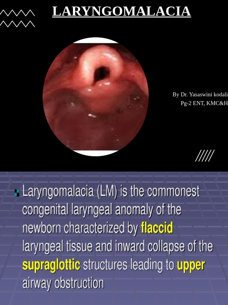 LARYNGOMALACIA 2 | PDF