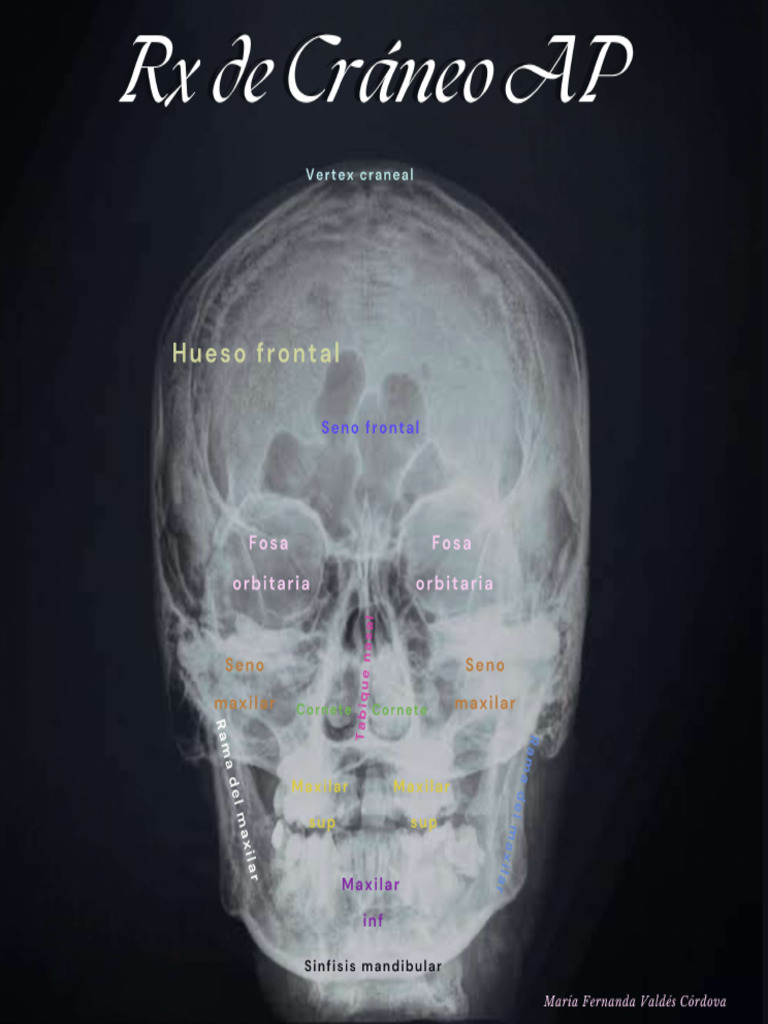 RX de Cráneo. AP y LAT. Mafer | PDF